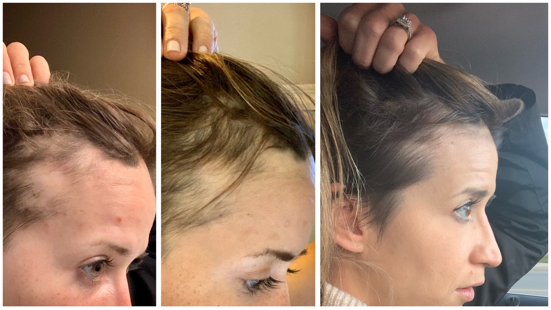 PRP Hair Restoration 10 - Medical Esthetics Thunder Bay